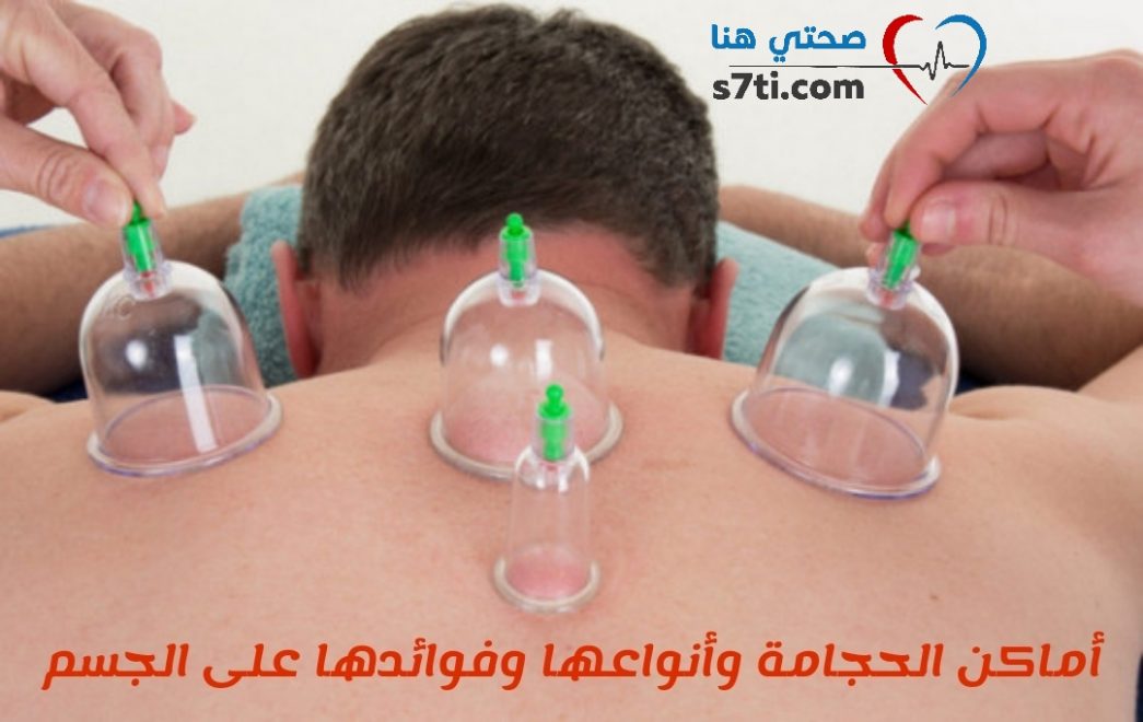 أماكن الحجامة وأنواعها ومعلومات عامة عنها صحتي هنا